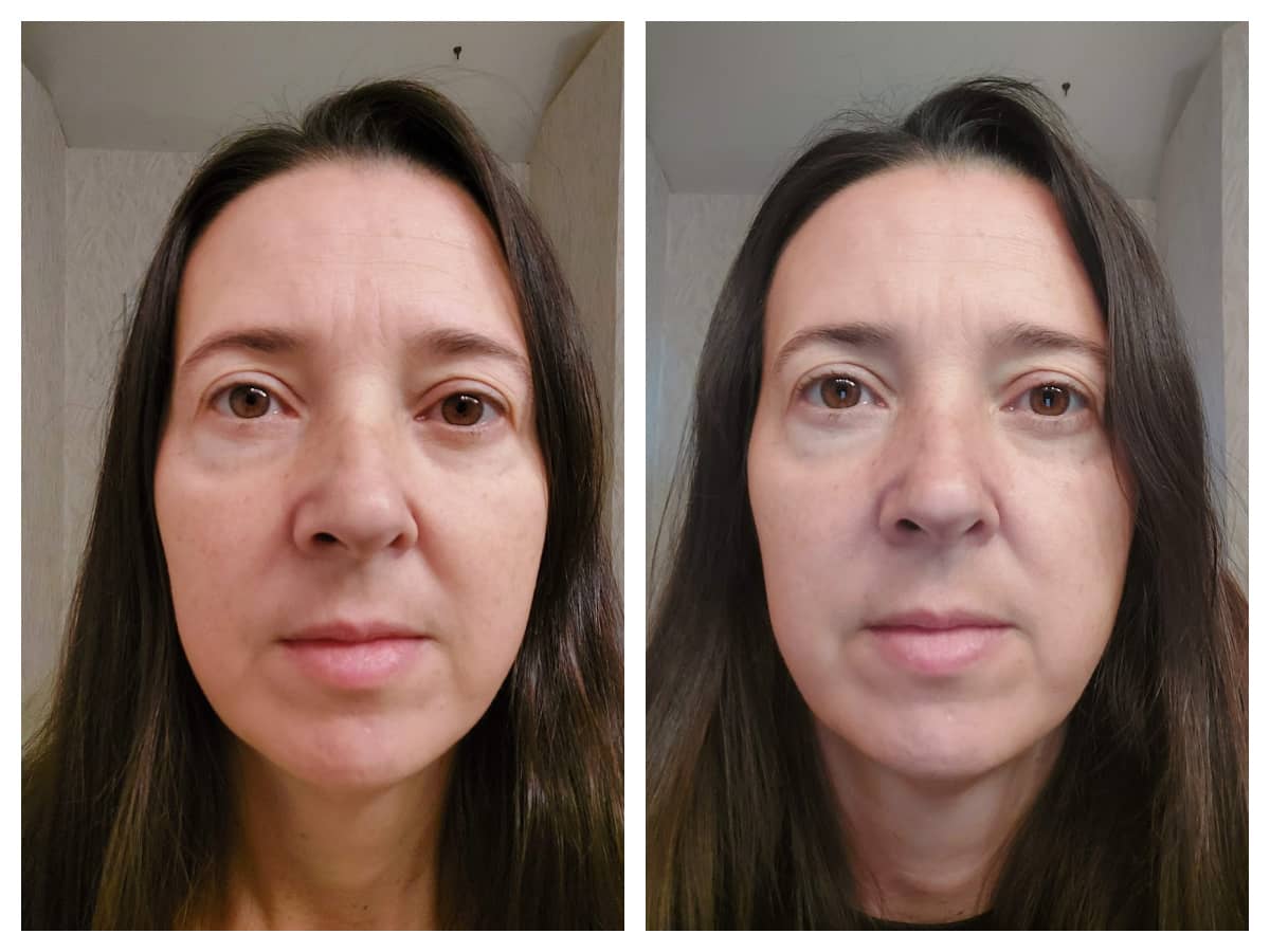 Sofwave Review: Non-Invasive Cosmetic Procedure